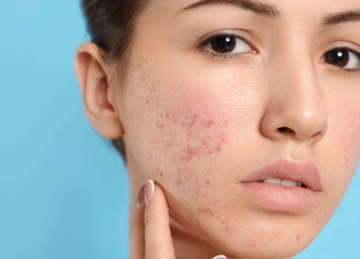 acne.com | Navigate your teen’s acne journey